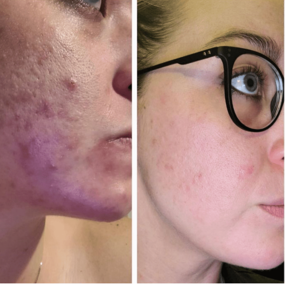 Acne Treatment Monroe, LA | Southlake, TX Acne Treatment